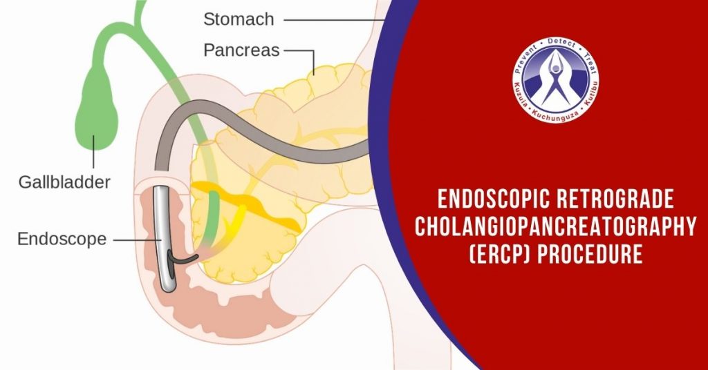 Endoscopic Retrograde Cholangiopancreatography Ercp Procedure
