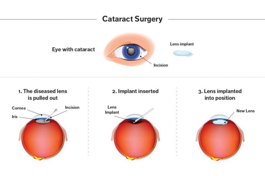 EVERYTHING YOU NEED TO KNOW ABOUT CATARACT! - OPHTHALMOLOGY