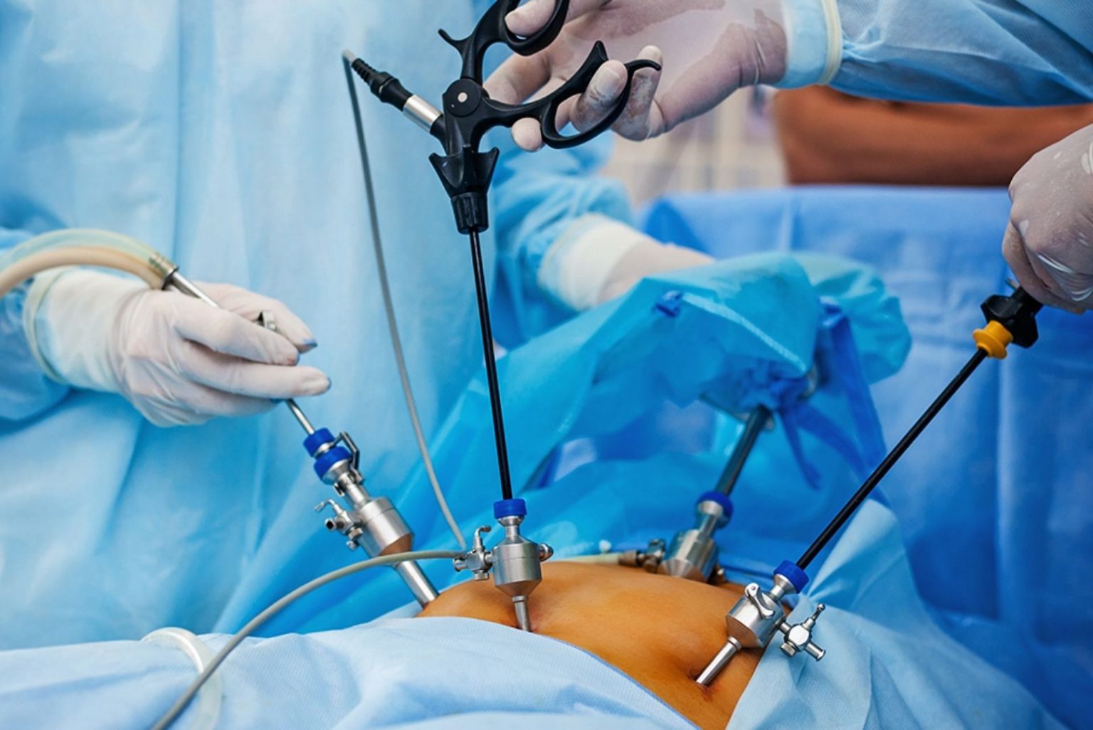 What Is Laparoscopic Surgery?